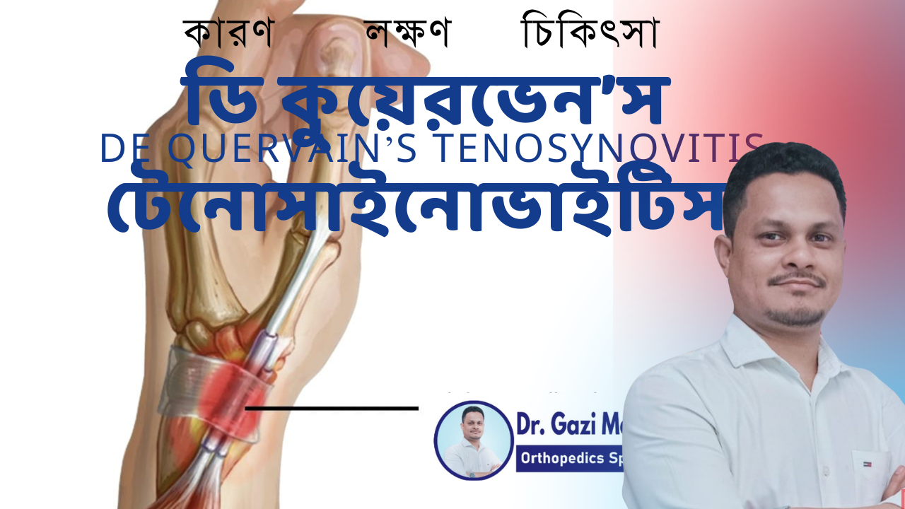 ডি কুয়েরভেন’স টেনোসাইনোভাইটিস (De Quervain’s Tenosynovitis) সম্পর্কে ...